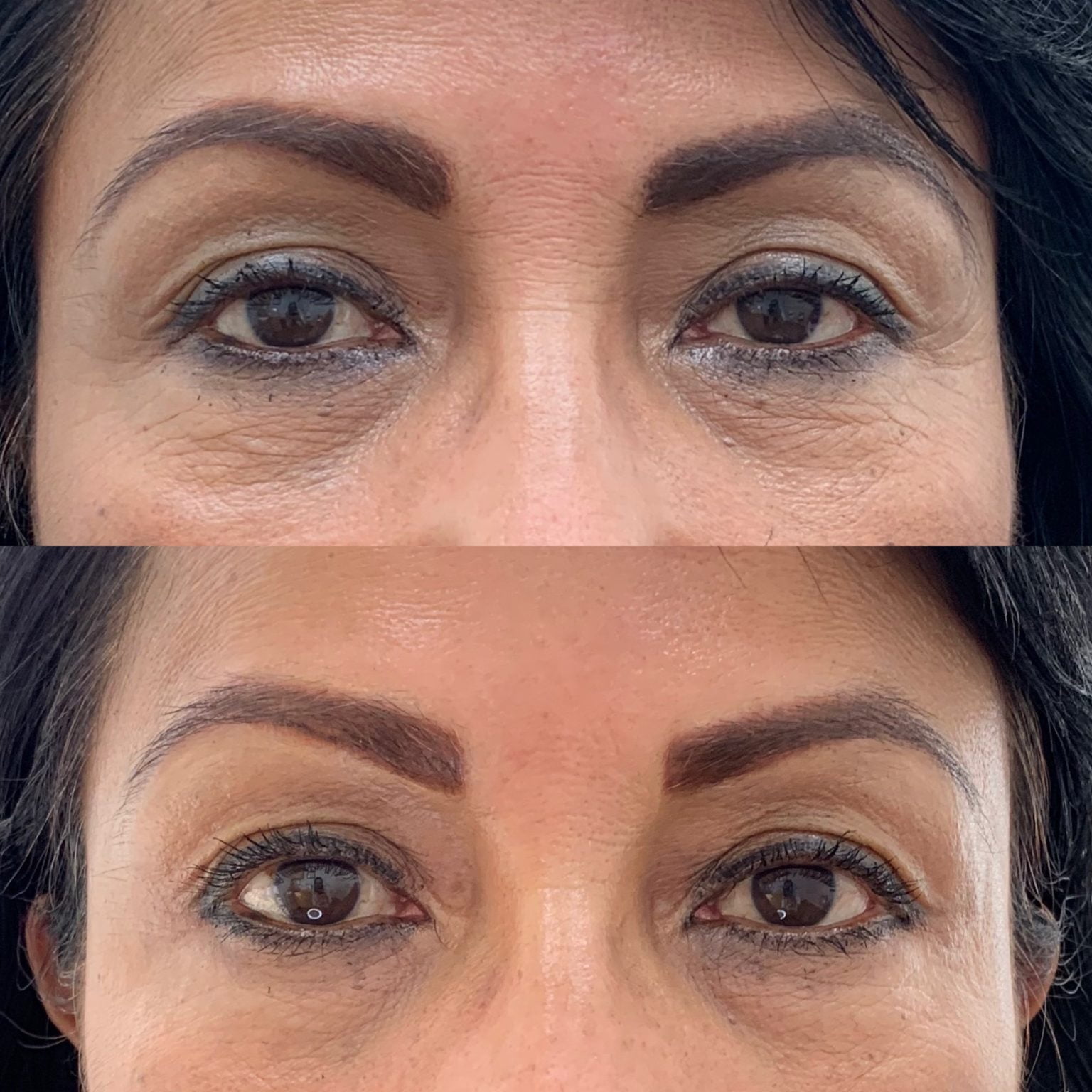 Botox Before and After - Beauty Boost Med Spa