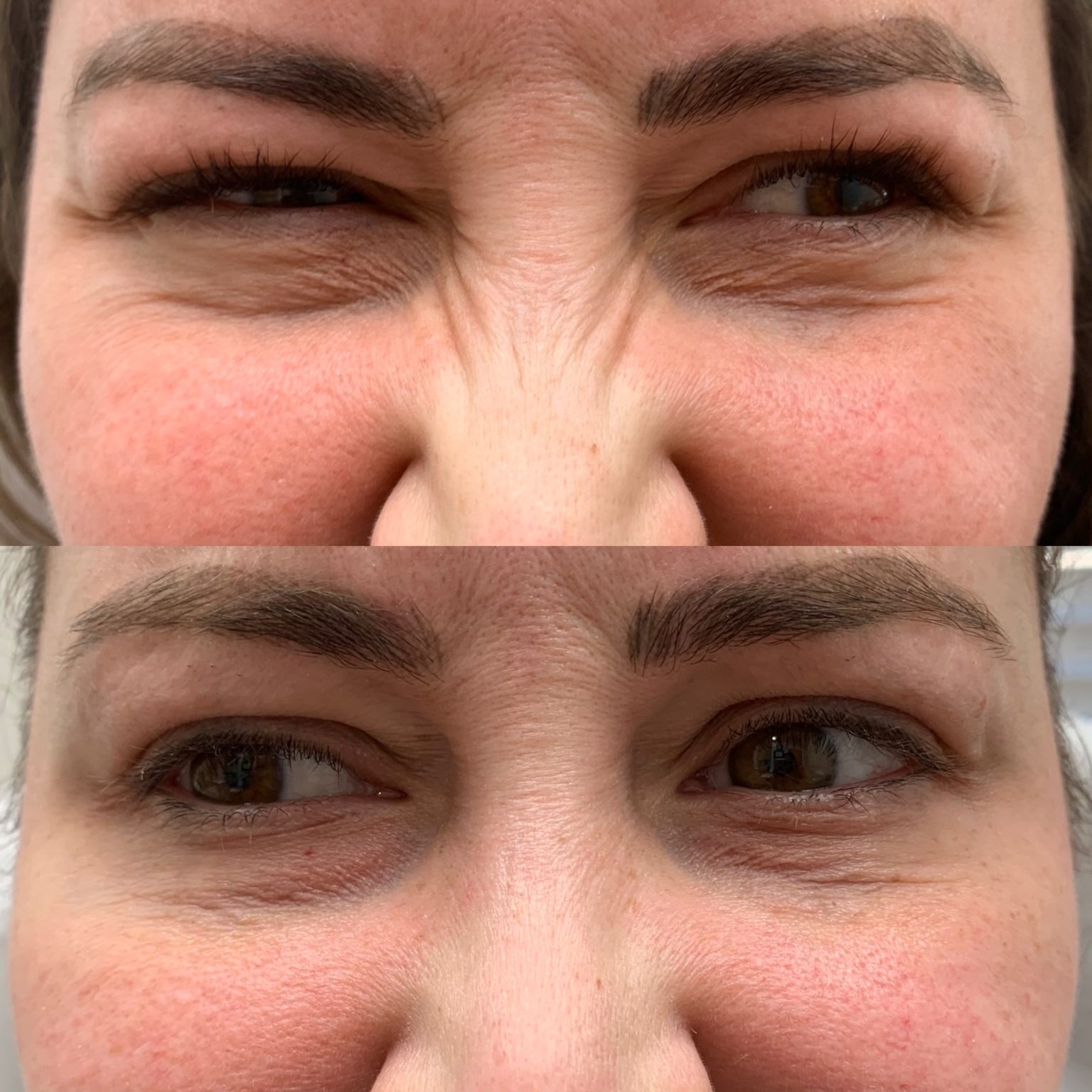 Botox Before and After - Beauty Boost Med Spa