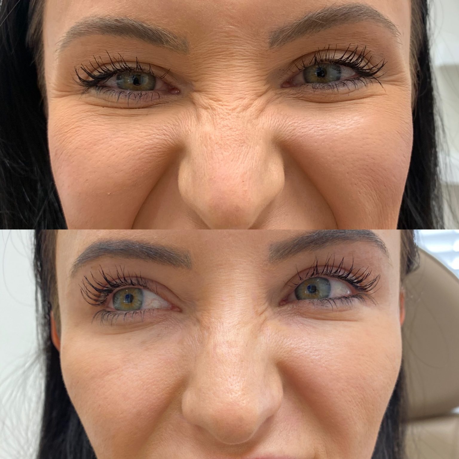 Botox Before and After - Beauty Boost Med Spa
