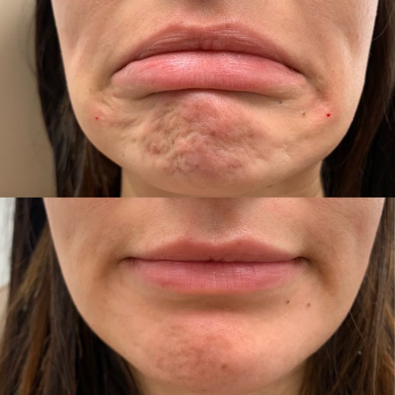 Before and After Botox | Beauty Boost in Newport Beach, CA