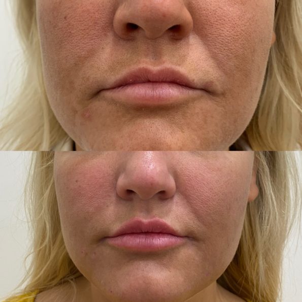 Botox Before and After - Beauty Boost Med Spa