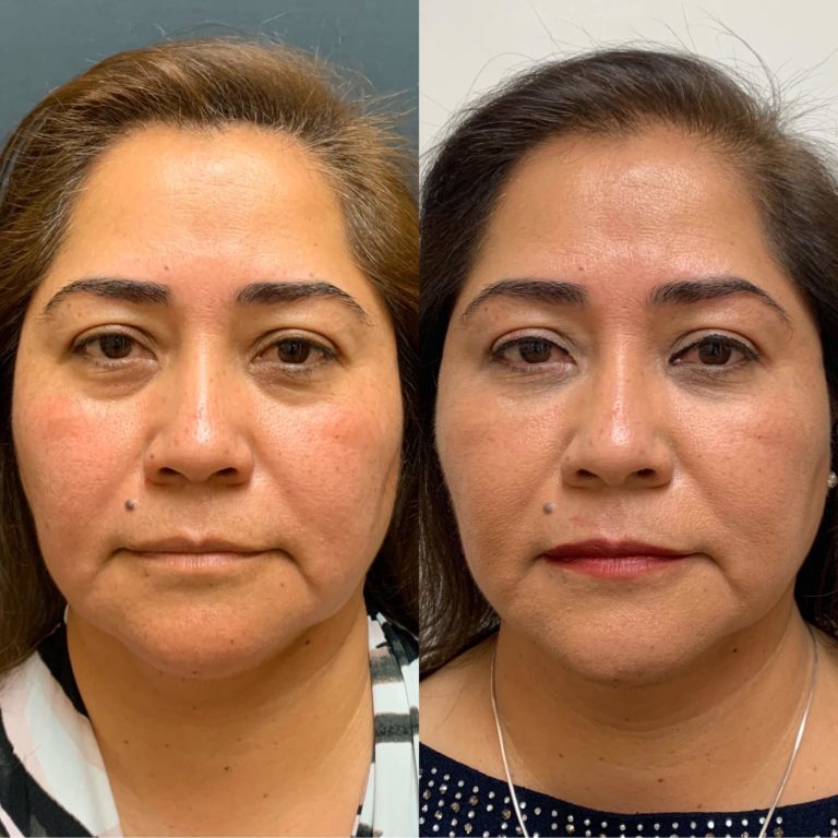 The Magic of PRP: Before And After - Beauty Boost Med Spa