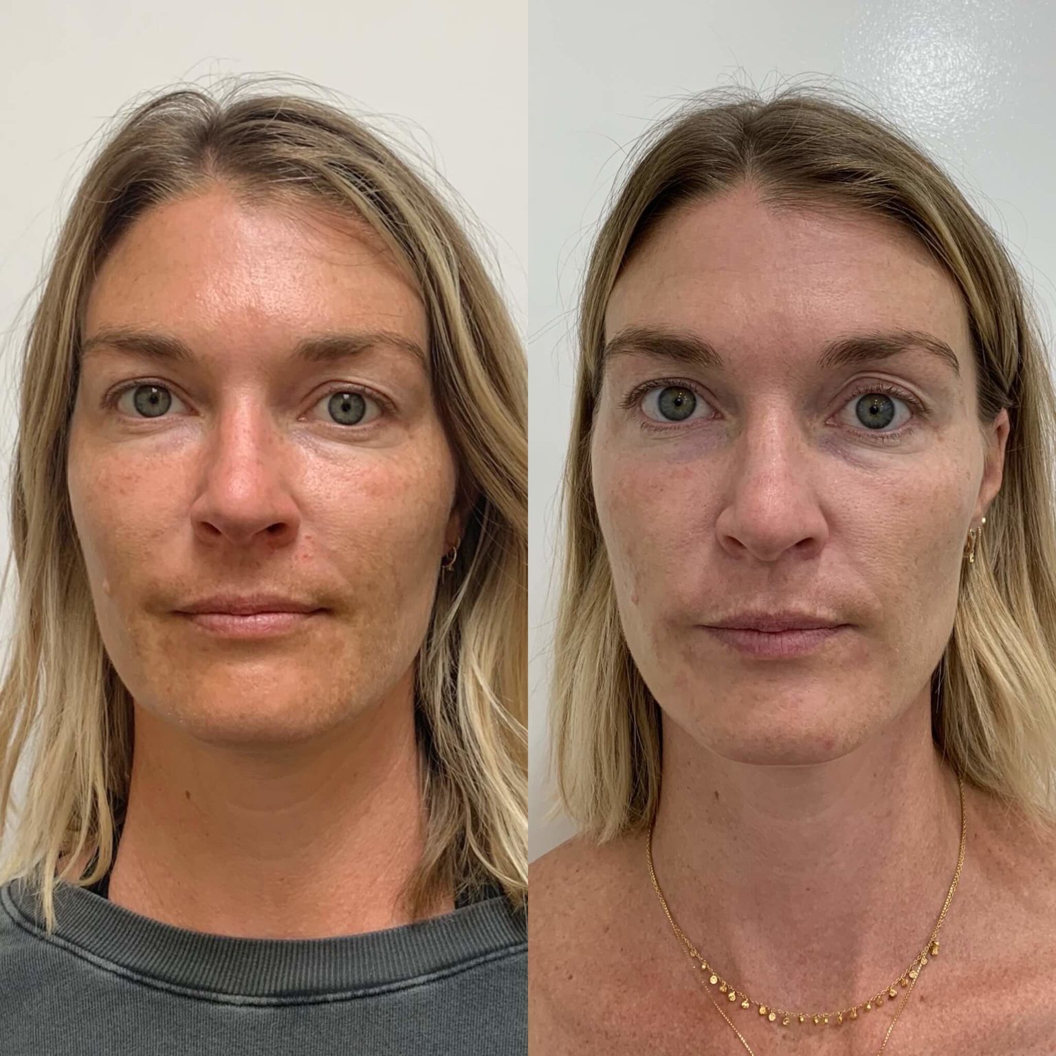 The Magic of PRP: Before And After - Beauty Boost Med Spa