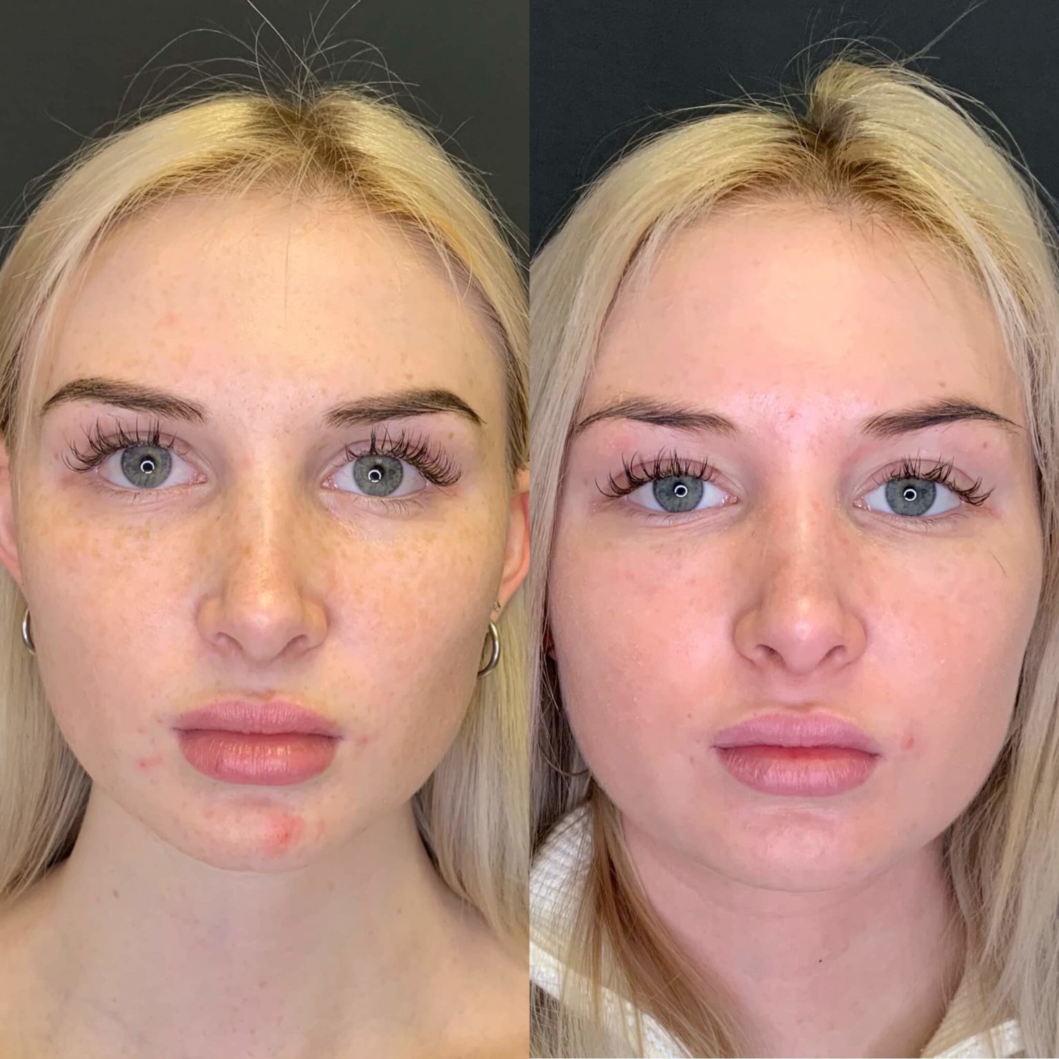 The Magic of PRP: Before And After - Beauty Boost Med Spa